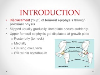Slipped capital femoral epiphysis (scfe) | PPTX