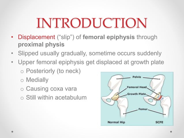 Slipped capital femoral epiphysis (scfe) | PPTX | Death, Injury, or ...