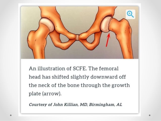 Slipped capital femoral epiphysis (scfe)
