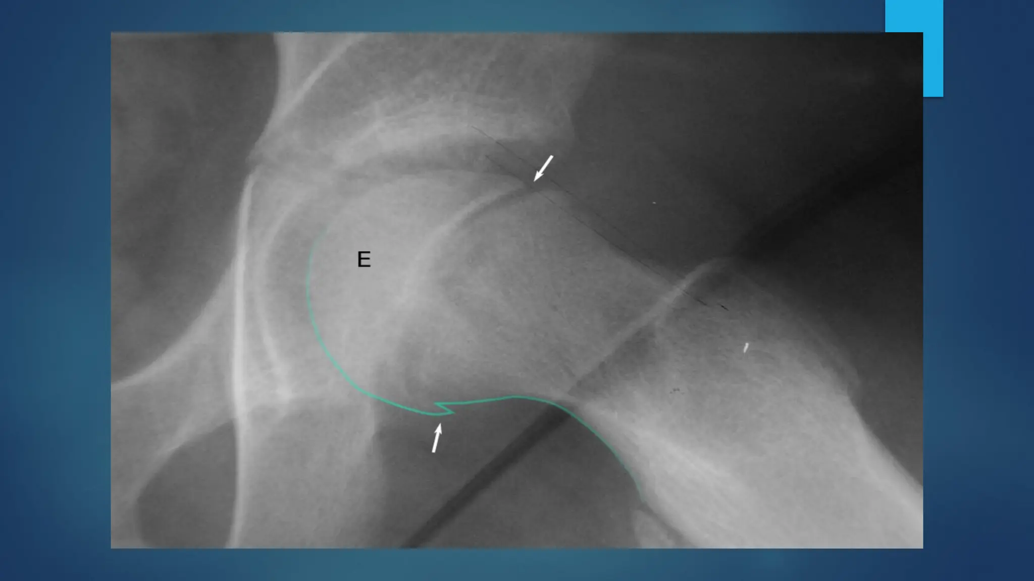 Slipped capital femoral epiphysis (SCFE).pptx