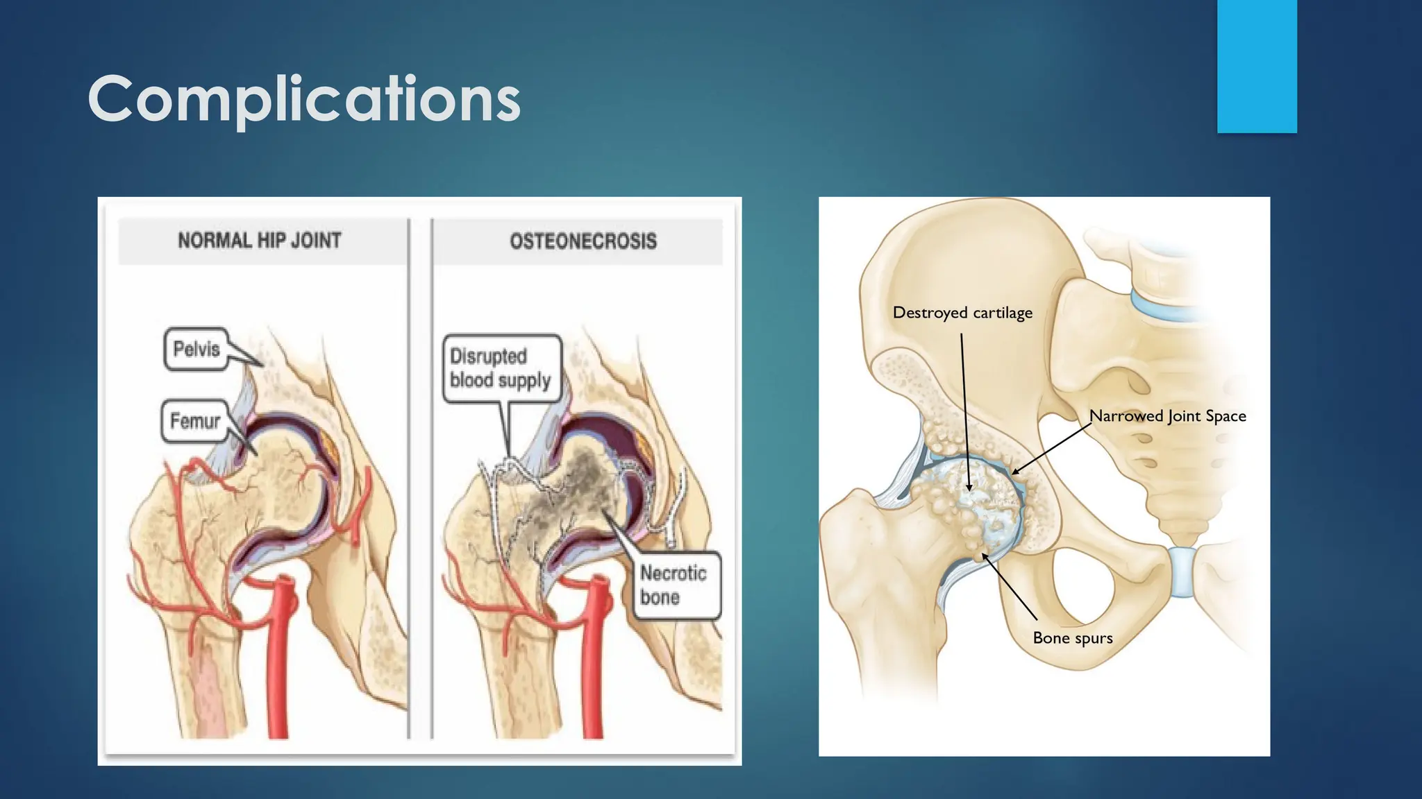 Slipped capital femoral epiphysis (SCFE).pptx