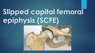 Slipped capital femoral epiphysis (SCFE).pptx