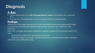 Slipped capital femoral epiphysis (SCFE).pptx