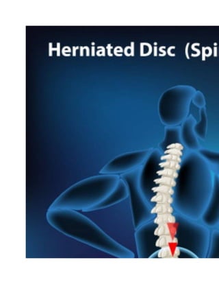 Slipped disc causes, symptoms and treatment. | DOCX