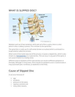 Slipped disc causes, symptoms and treatment. | DOCX