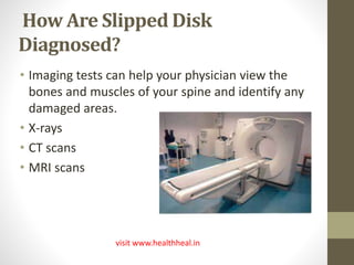 Slipped disk | PPTX