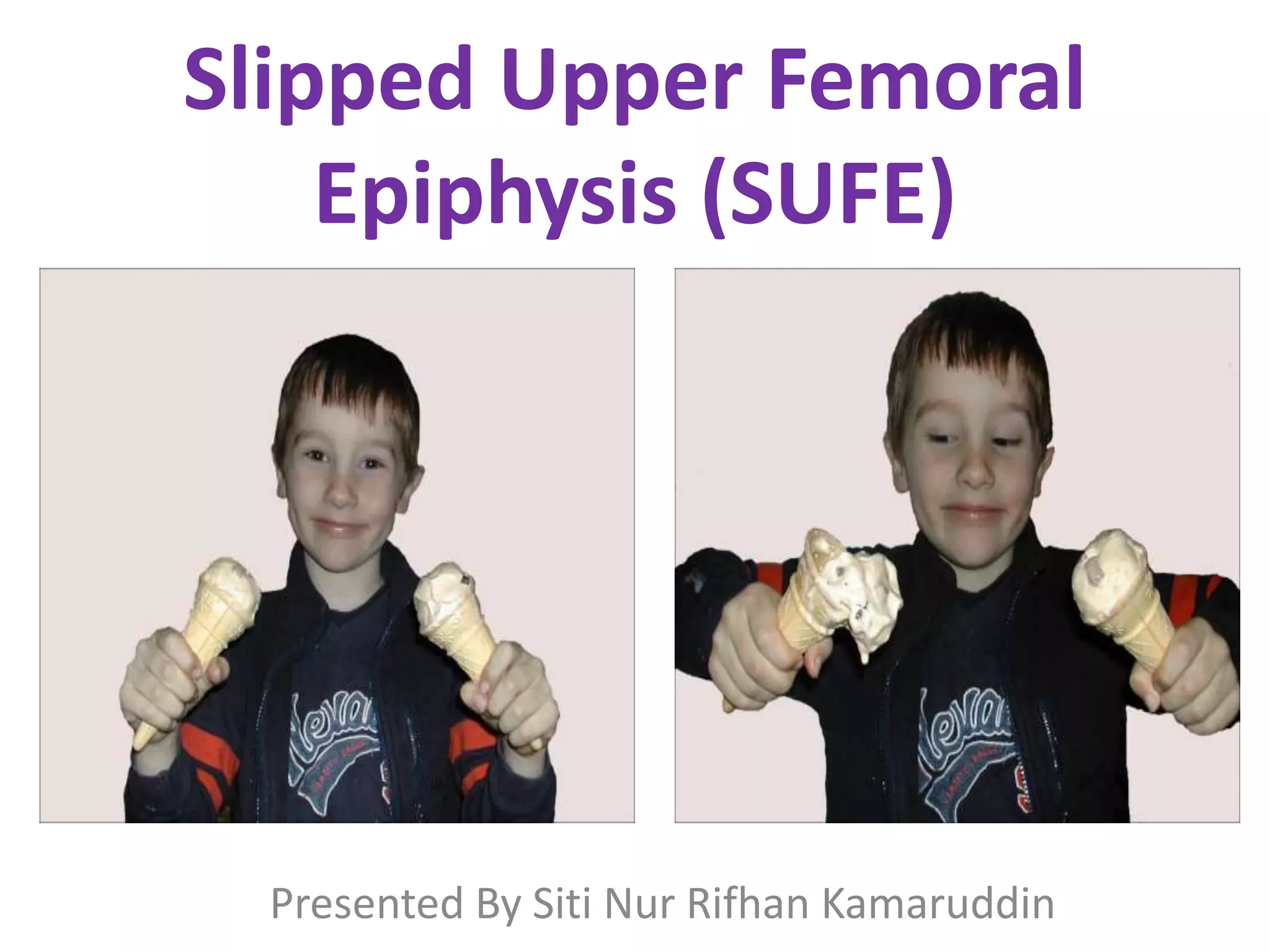 Slipped Upper Femoral Epiphysis (SUFE) | PPTX