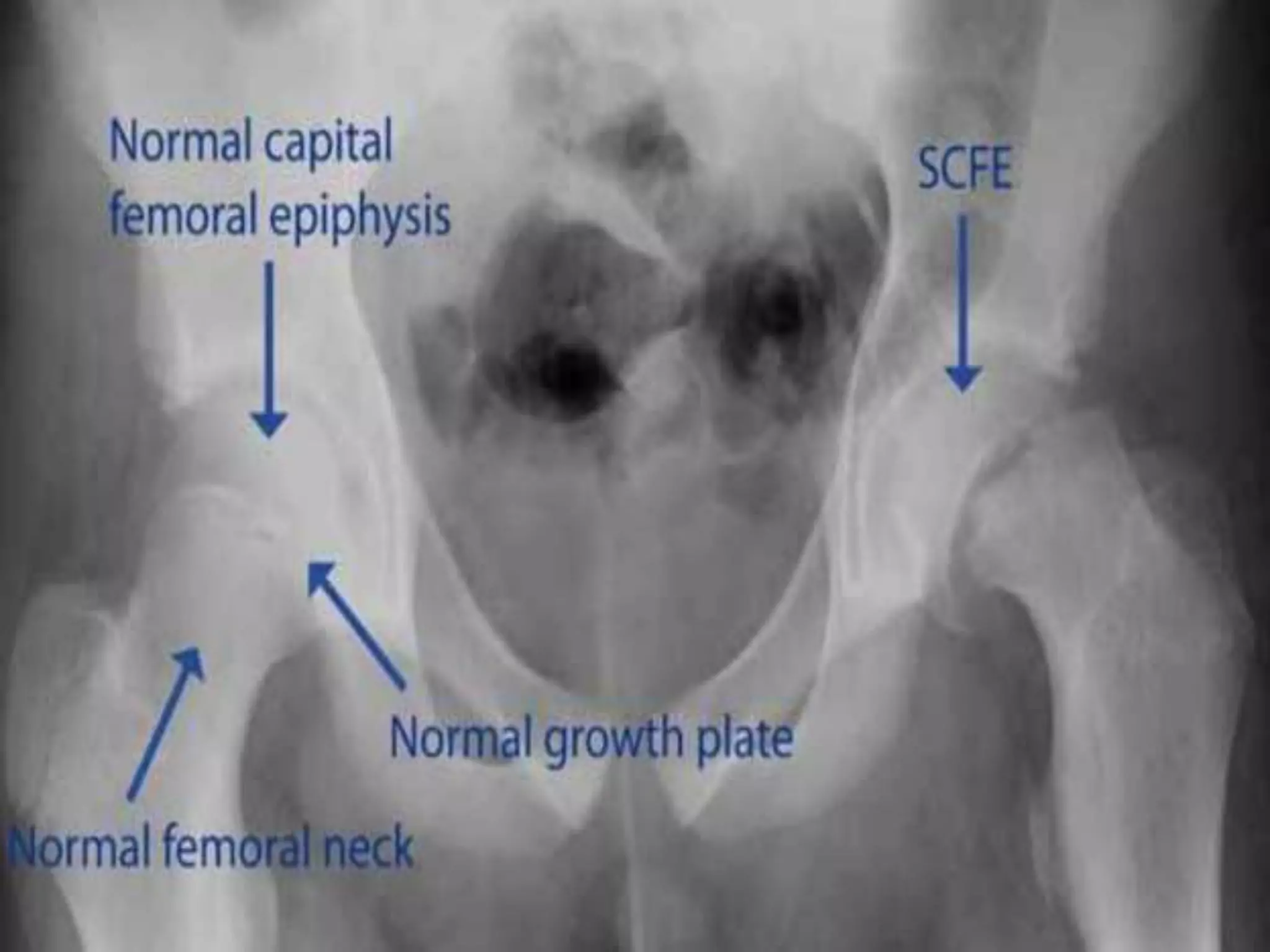 Slipped Upper Femoral Epiphysis (SUFE) | PPTX
