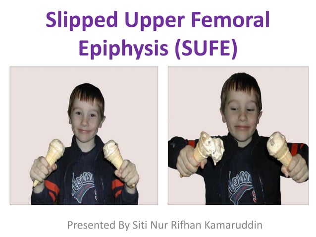 Slipped Upper Femoral Epiphysis (SUFE) | PPT