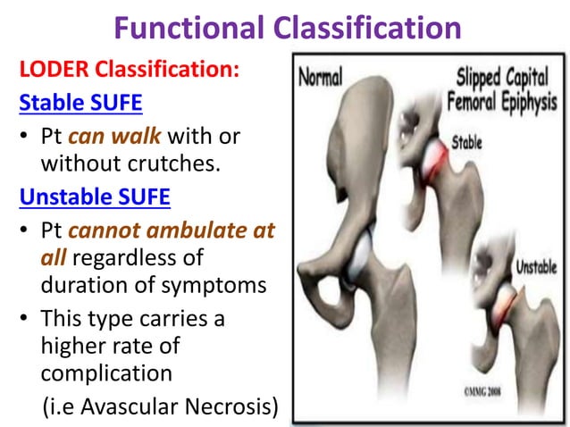Slipped Upper Femoral Epiphysis (SUFE) | PPTX | Bone and Joint ...