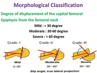 Slipped Upper Femoral Epiphysis (SUFE) | PPTX