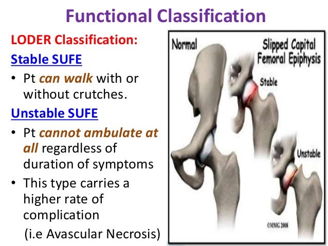 Slipped Upper Femoral Epiphysis (SUFE)