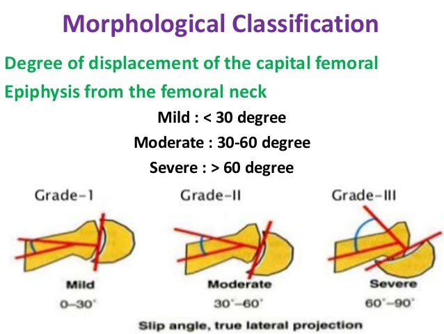 Slipped Upper Femoral Epiphysis (SUFE)