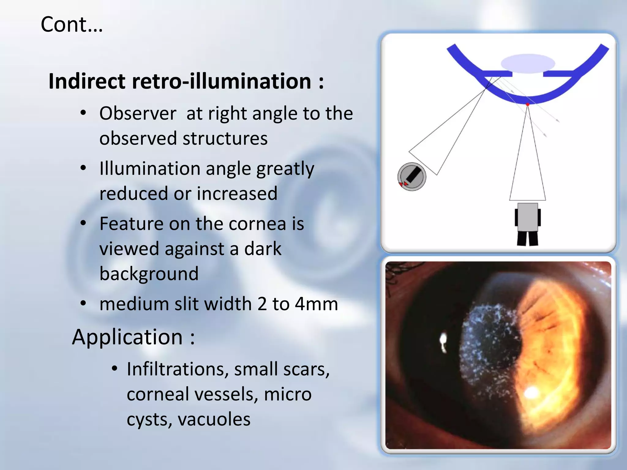 Slit lamp biomicroscope | PDF