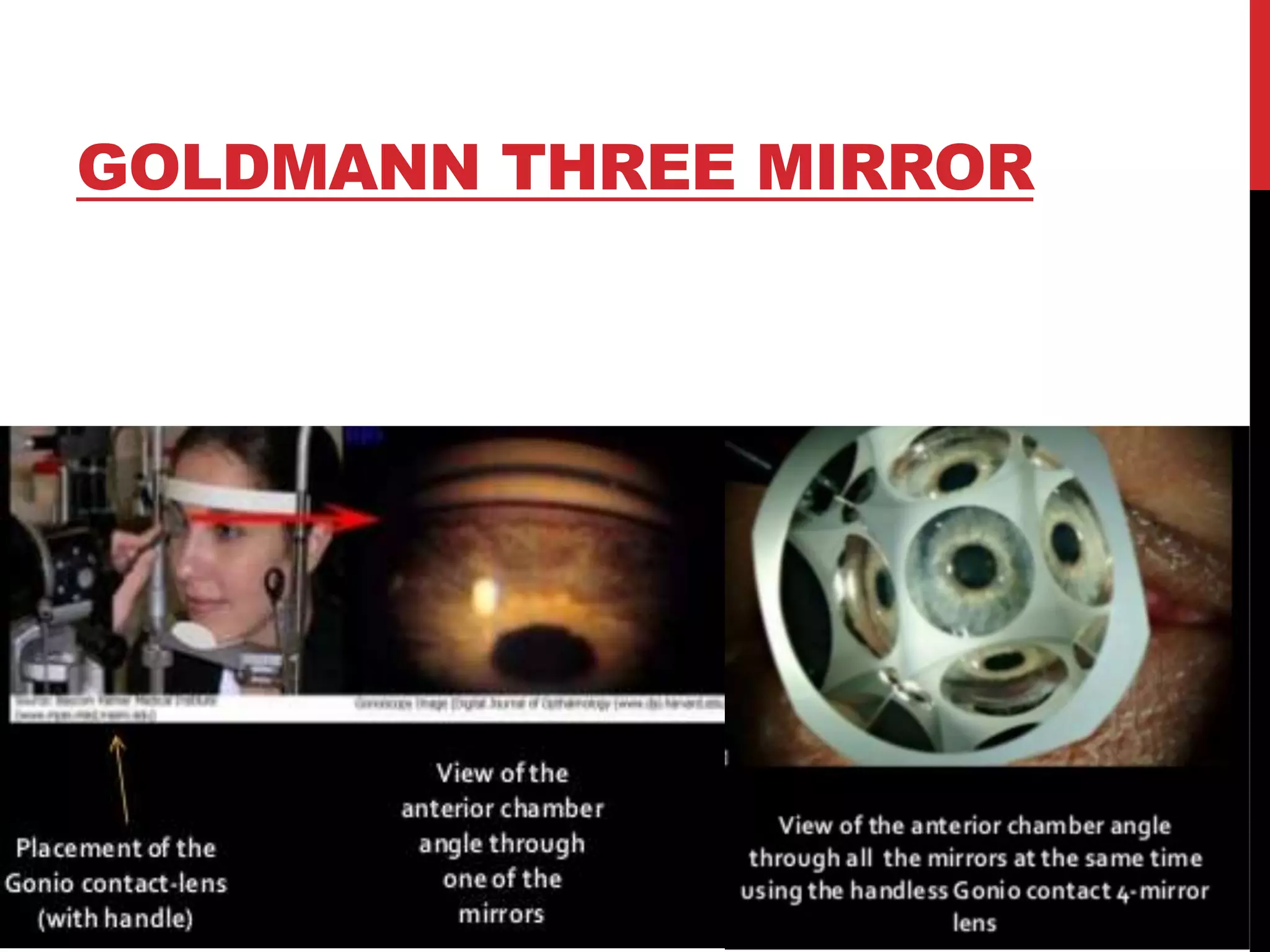 Lenses of slit lamp biomicroscope & indirect ophthalmoscope. | PPTX