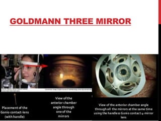 Lenses of slit lamp biomicroscope & indirect ophthalmoscope. | PPTX