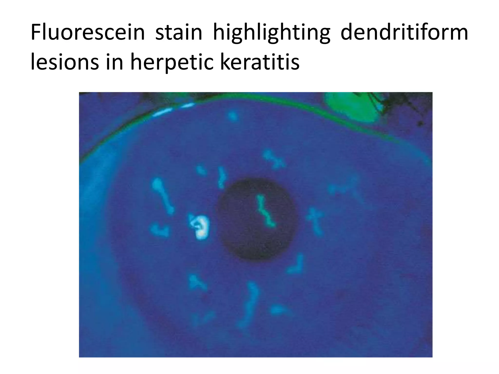 Slit lamp biomicroscopy and illumination techniques | PPTX