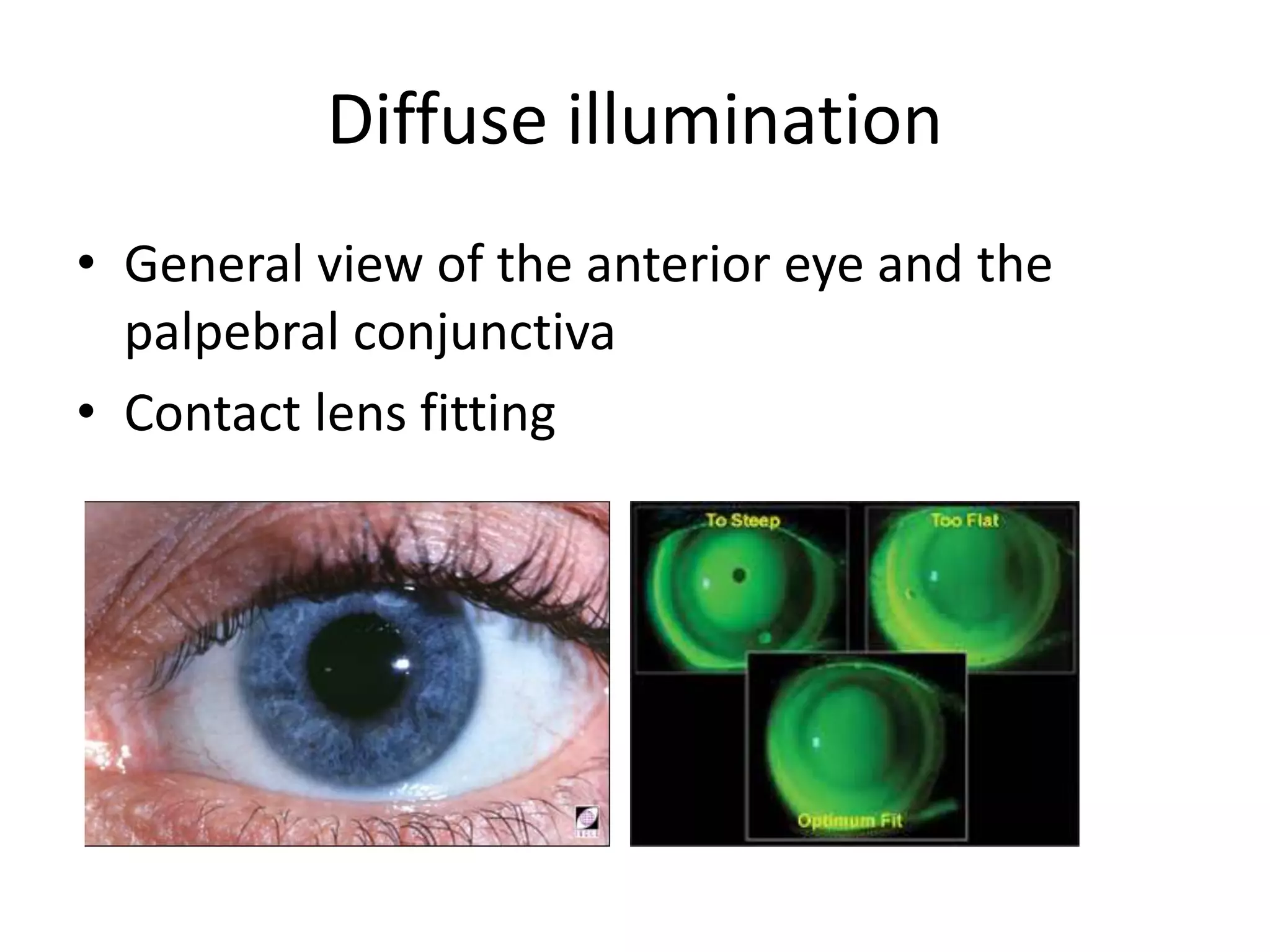 Slit lamp biomicroscopy and illumination techniques | PPTX