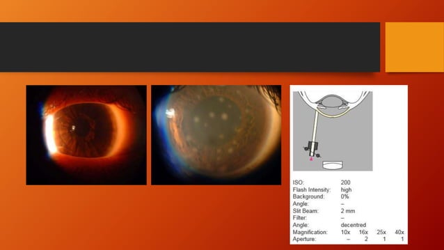 Slit lamp (methods of illumination) | PPTX | Eye and Vision Conditions ...