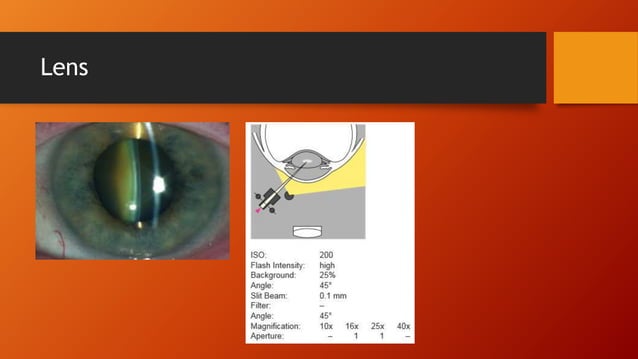 Slit lamp (methods of illumination) | PPTX | Eye and Vision Conditions ...