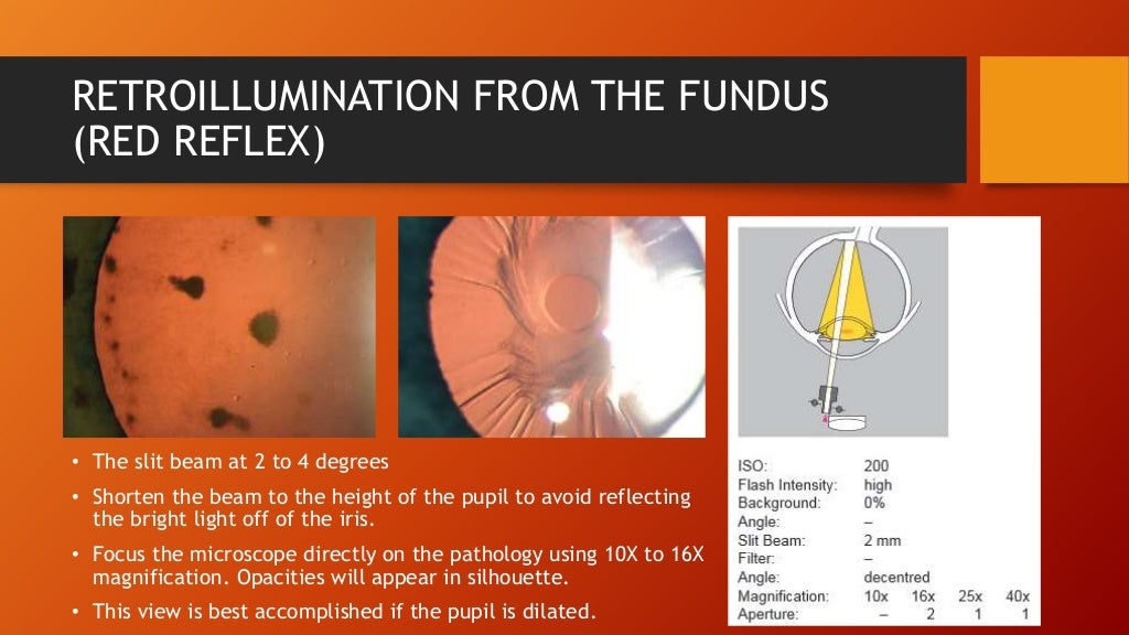 Slit lamp (methods of illumination)