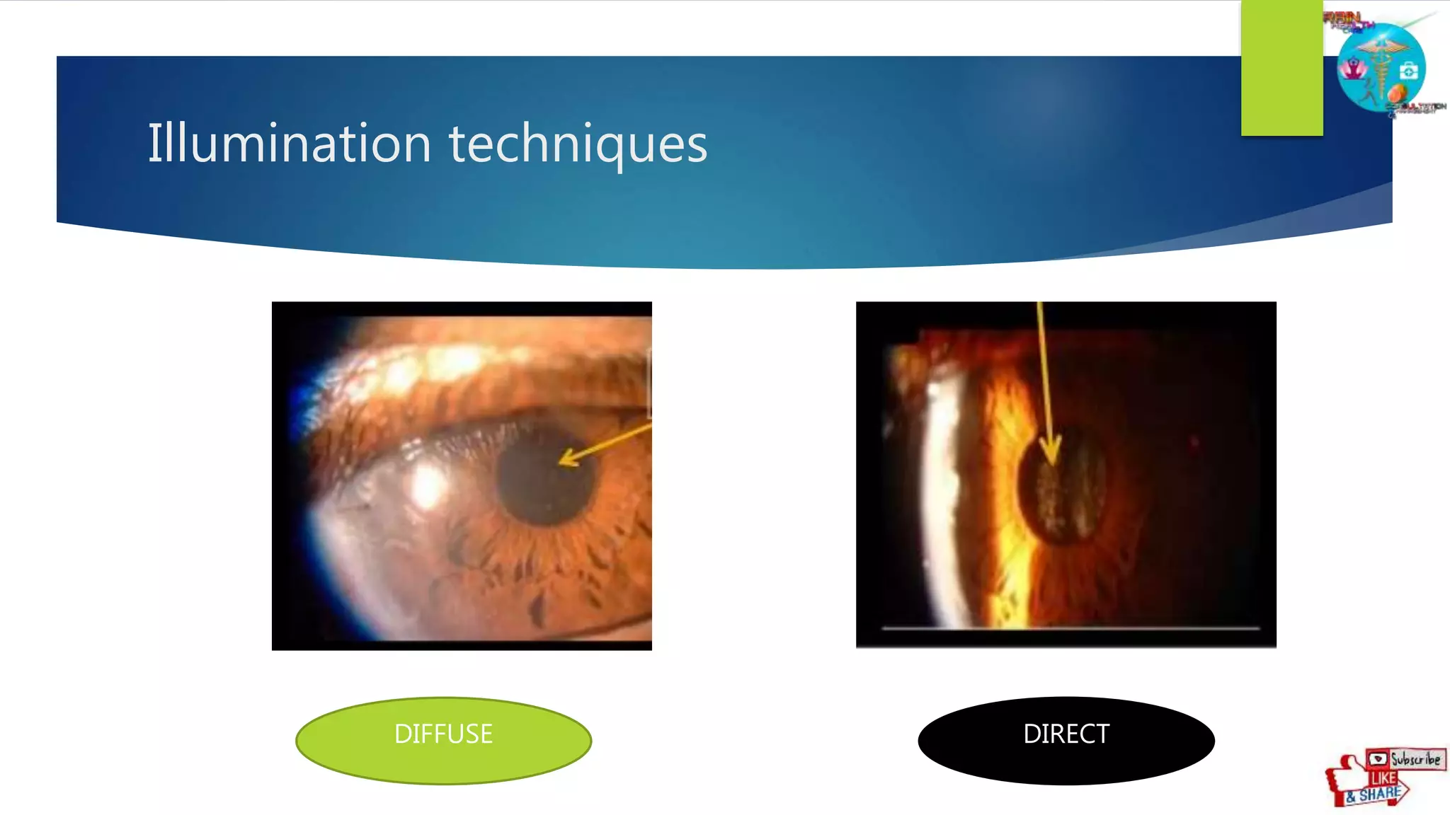 Slit lamp | PPTX