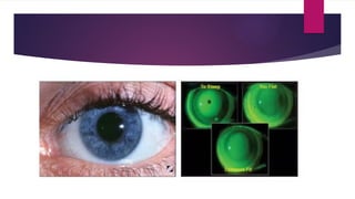 Slit Lamp Biomicroscopy: Principles, Components, Illumination ...