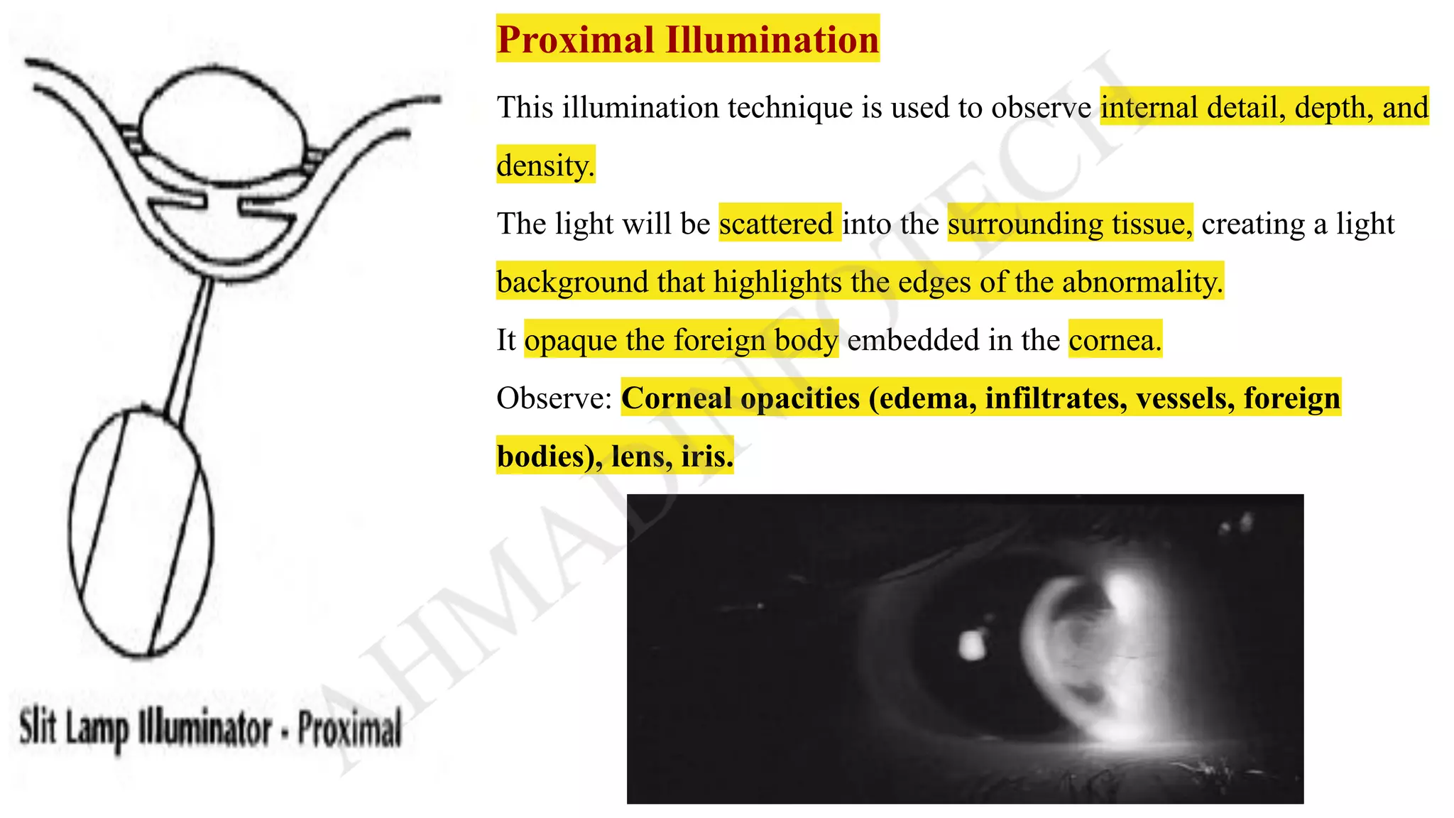 what is slit lamp Biomicroscopy | What is a slit lamp exam used for ...