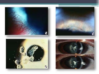 SLIT LAMP AND ITS DIFFERENT ILLUMINATION TECHNIQUES.pptx