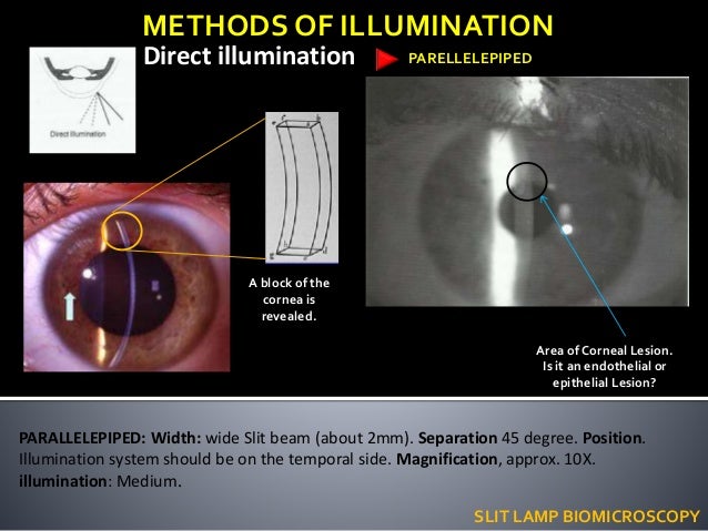 Slit lamp biomicroscopy.