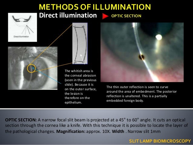 Slit lamp biomicroscopy.