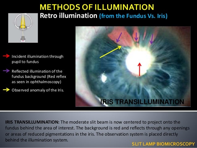 Slit lamp biomicroscopy.