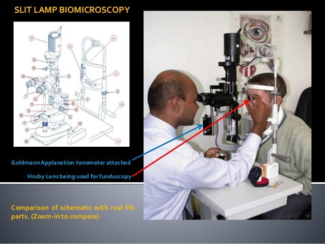 Slit lamp biomicroscopy.