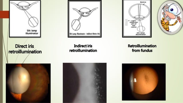 Slit lamp biomicroscopy