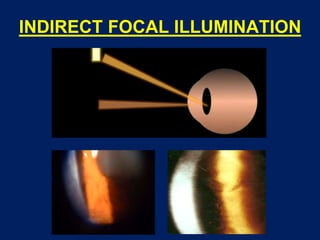 Slit lamp biomicroscopy | PPT