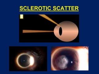 Slit lamp biomicroscopy | PPT