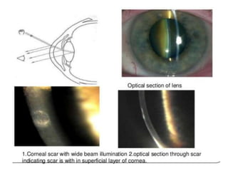 Slit Lamp Biomicroscopy.ecamination , types and procedures | PPTX