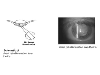 Slit Lamp Biomicroscopy.ecamination , types and procedures | PPTX