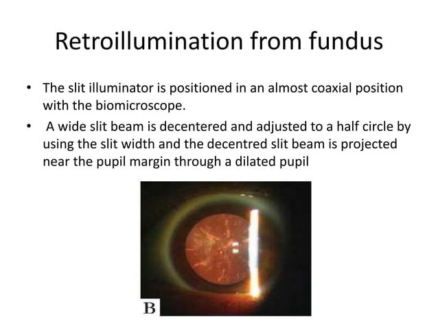 Slit Lamp Biomicroscopy.ecamination , types and procedures | PPT