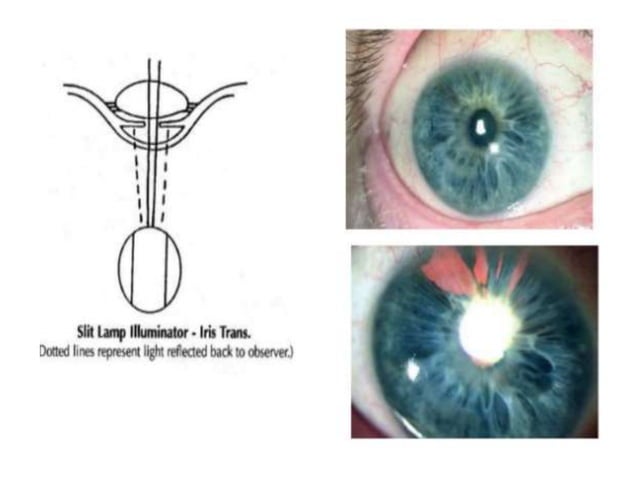 Slit Lamp Biomicroscopy.ecamination , types and procedures | PPT