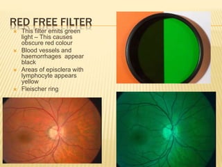 Slit lamp – biomicroscopy of eye | PPTX