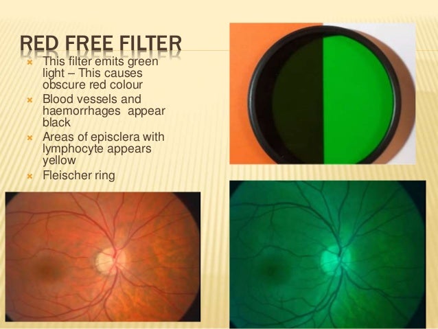 Slit lamp – biomicroscopy of eye