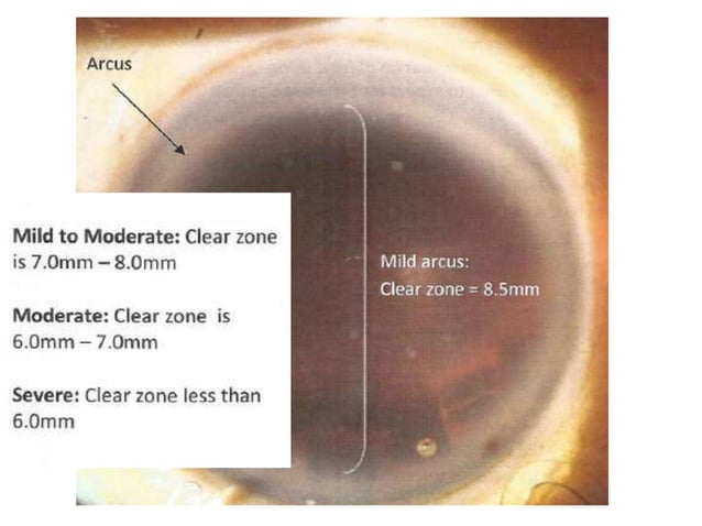 Slit Lamp Evaluation of Cornea | PPTX | Eye and Vision Conditions ...