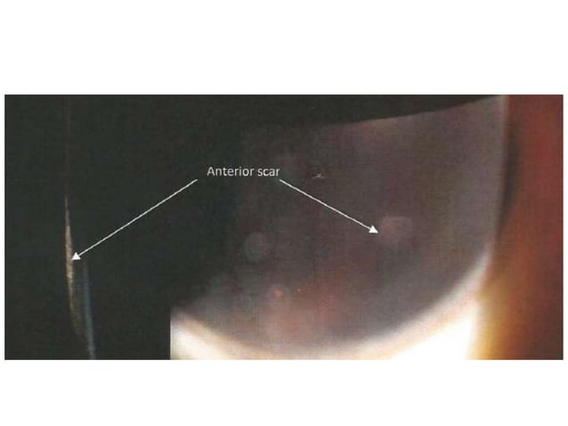 Slit Lamp Evaluation of Cornea | PPTX | Eye and Vision Conditions ...