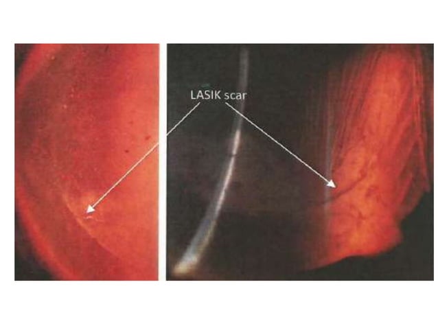 Slit Lamp Evaluation of Cornea | PPTX | Eye and Vision Conditions ...