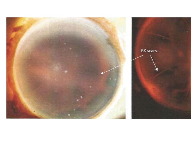 Slit Lamp Evaluation of Cornea | PPTX | Eye and Vision Conditions ...