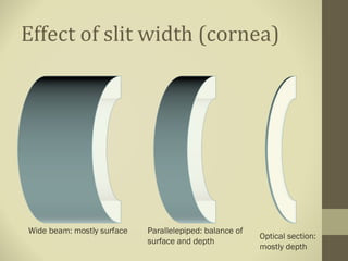Corneal Parallelepiped