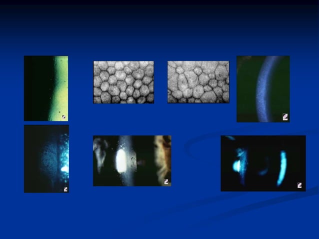 Slit lamp examination.ppt | Eye and Vision Conditions | Diseases and ...