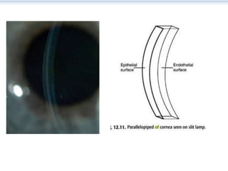 Corneal Parallelepiped