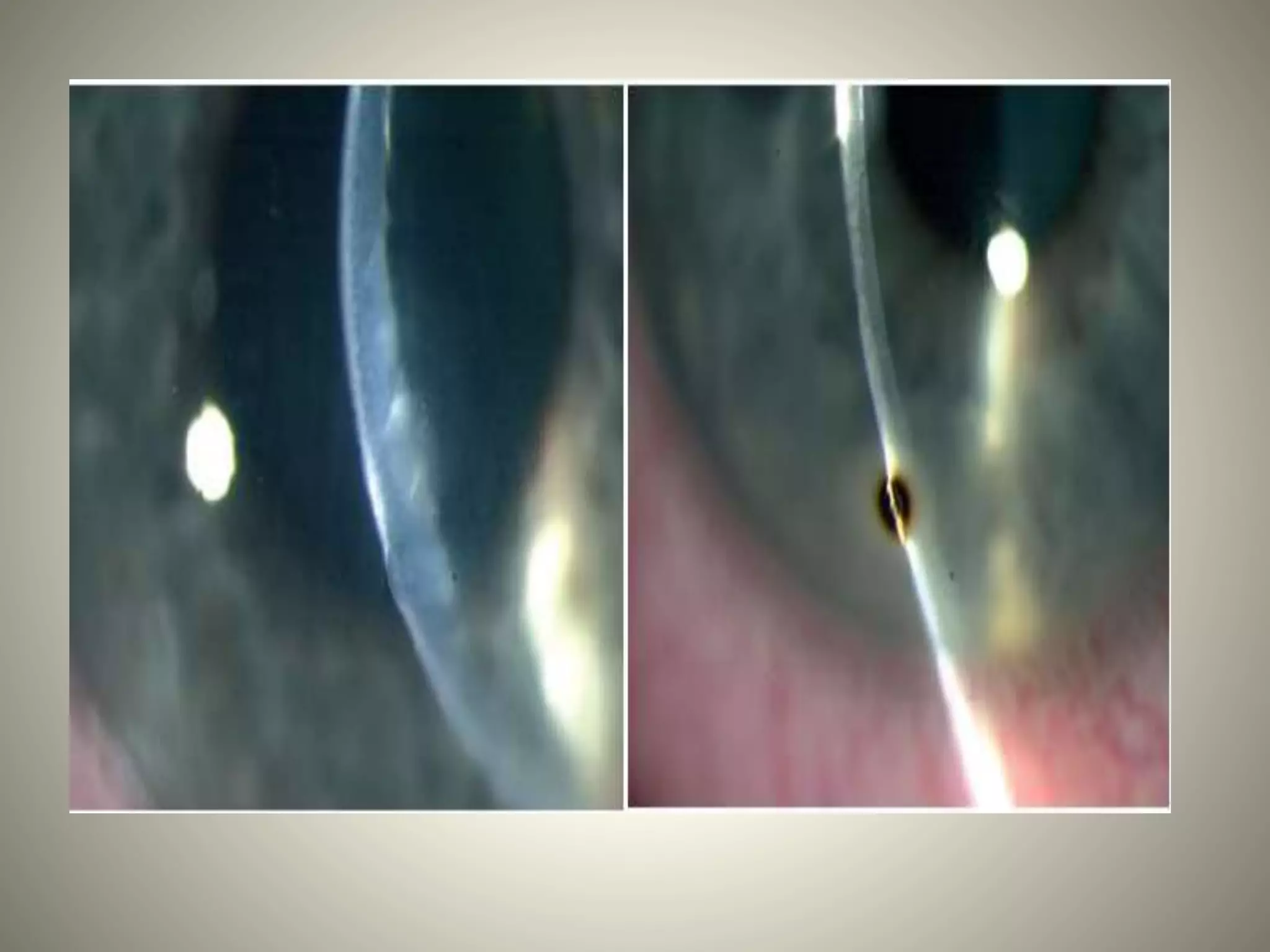 Slit lamp examination lecture | PPTX